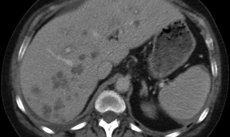 A multisystem granulomatous disease: necrobiotic xanthogranuloma with ...