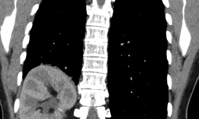 A rare cause of intrathoracic mass | The Medical Journal of Australia