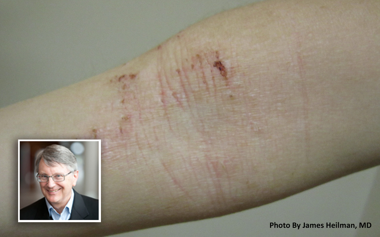 MJA Podcasts 2017 Episode 64: Atopic dermatitis, with Prof Alan Cooper ...