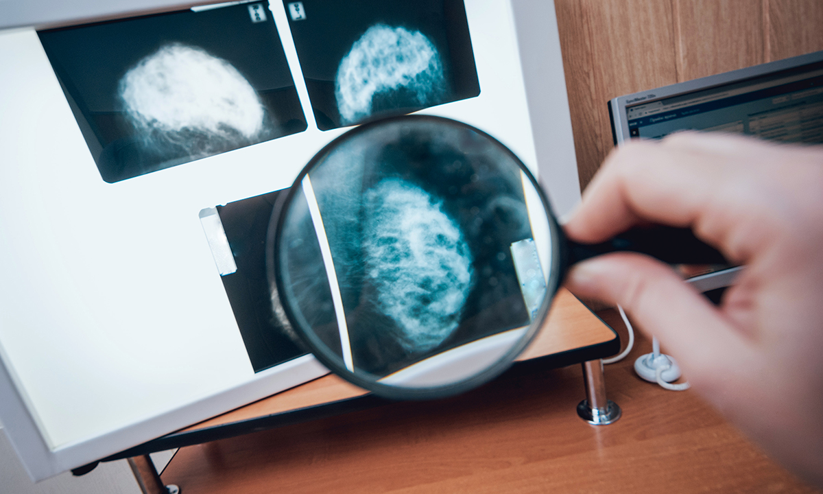 Universal genetic testing of patients with newly diagnosed breast ...