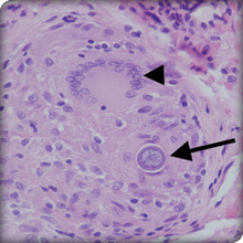 Coccidioidal septic arthritis: lessons learned from a clinical and ...