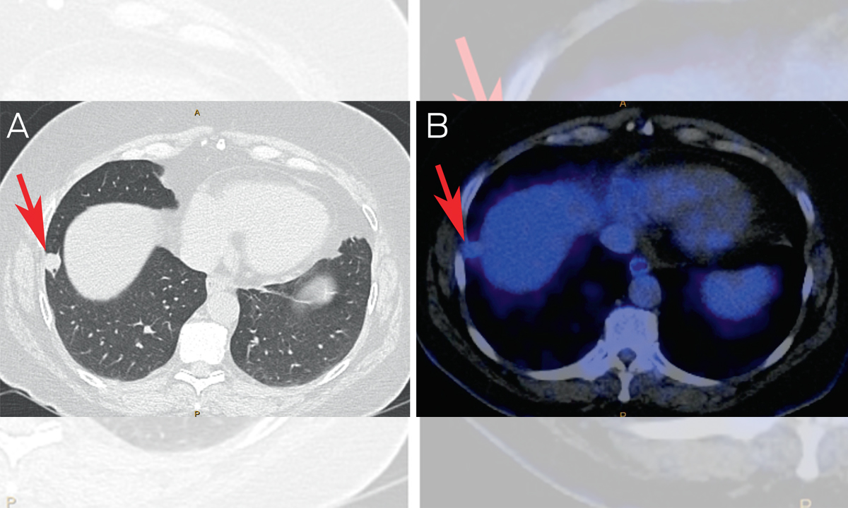 Human pulmonary dirofilariasis: an unexpected differential diagnosis ...