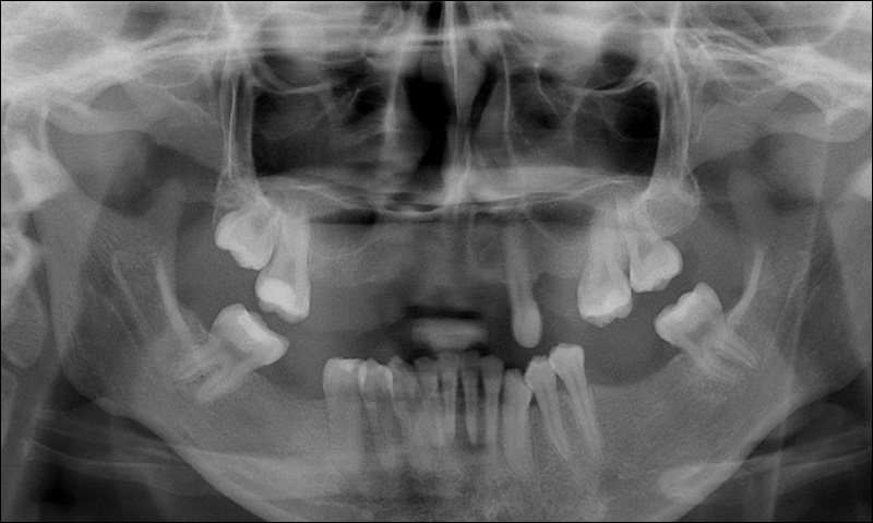 Pyogenic brain abscess due to Streptococcus anginosus | The Medical ...