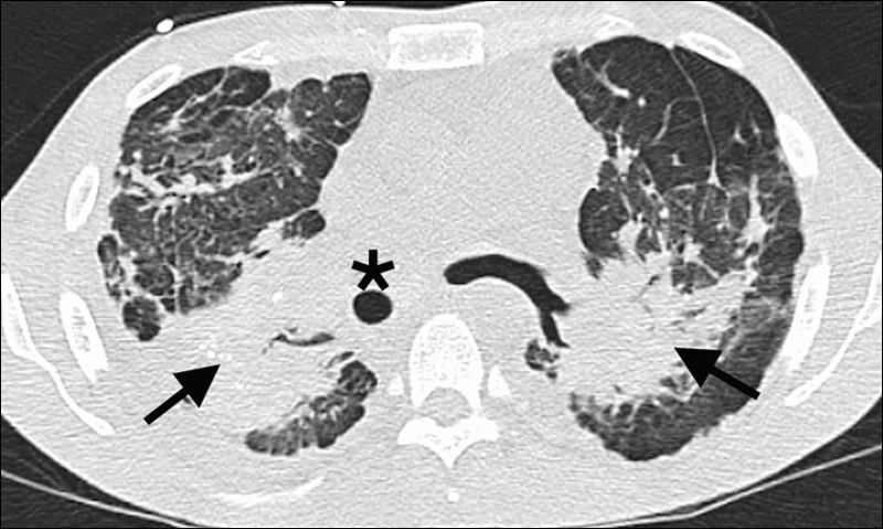 Bilateral upper lobe opacification | The Medical Journal of Australia