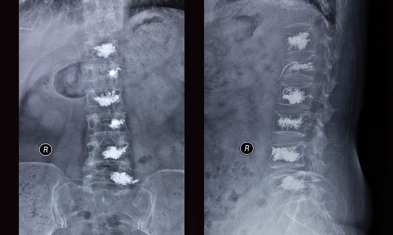 Vertebroplasty is not a do-not-do treatment | The Medical Journal of ...