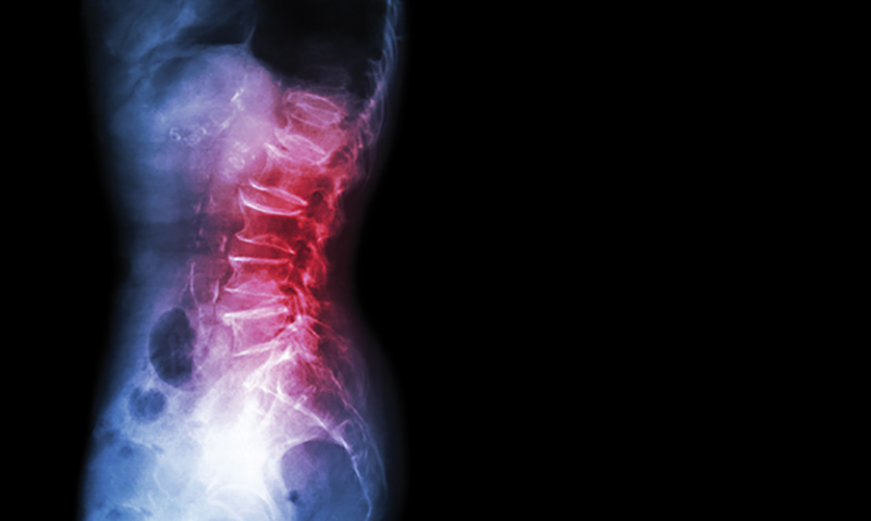 Surgical management of low back pain | The Medical Journal of Australia