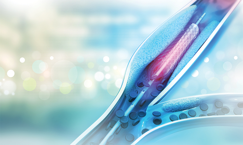 New developments in coronary stent technology | The Medical Journal of ...