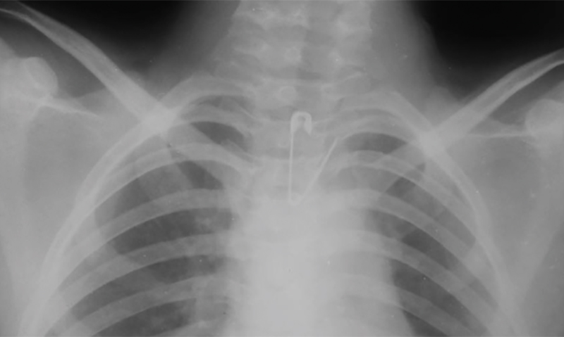 A not so safe safety pin! | The Medical Journal of Australia