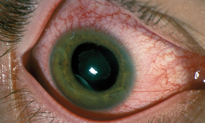 Ocular complications of rheumatic diseases | The Medical Journal of ...
