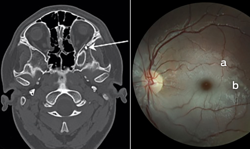 A blinding eye injury caused by chasing Pokémon | The Medical Journal ...