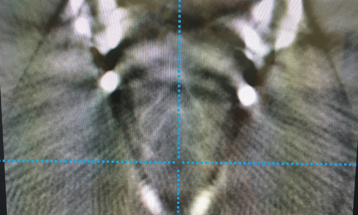 Stereotactic neurosurgery | The Medical Journal of Australia