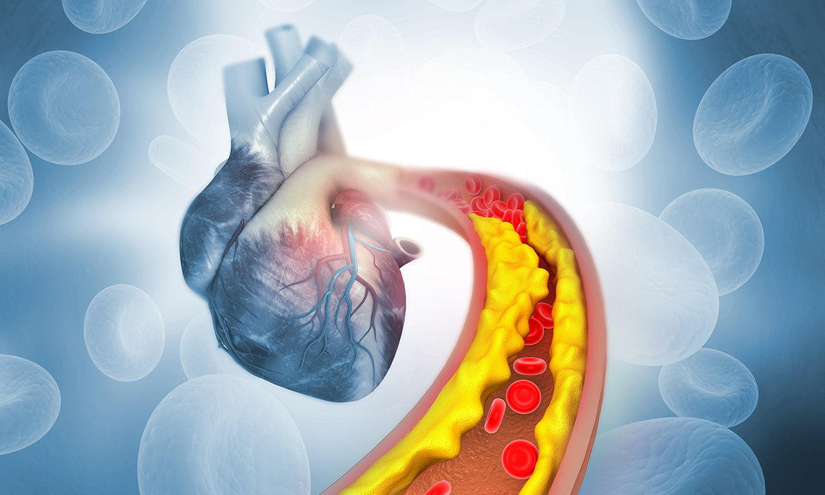 An updated review of lipid‐modifying therapy | The Medical Journal of ...
