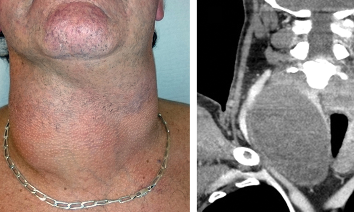 Sudden enlargement of the neck | The Medical Journal of Australia