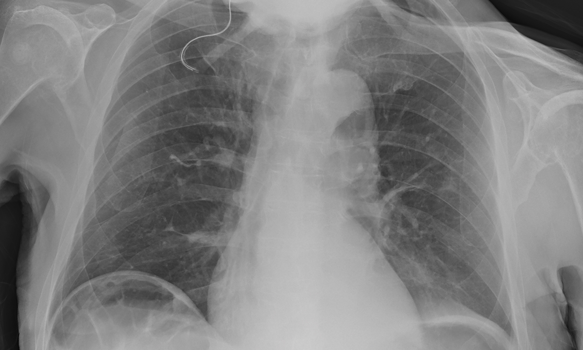 Chilaiditi sign | The Medical Journal of Australia