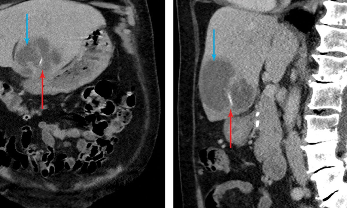 Pyogenic hepatic abscess secondary to gastric perforation caused by an ...