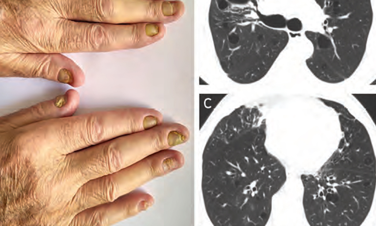 Yellow nails syndrome: complete triad | The Medical Journal of Australia