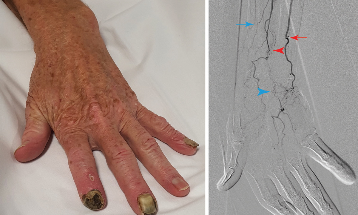 A curious case of finger pain | The Medical Journal of Australia