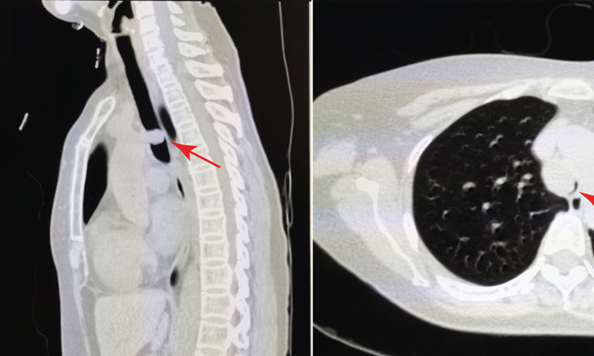 Tracheal obstruction caused by pleomorphic adenoma | The Medical ...