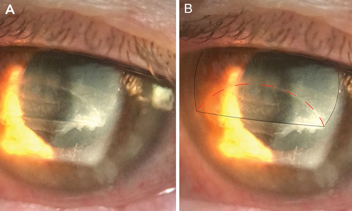 More than meets the eye: a missed traumatic laser in situ ...