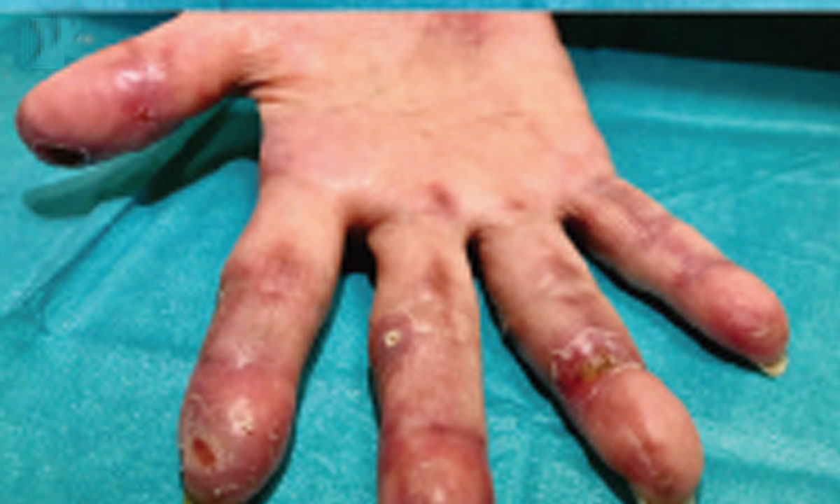 Anti‐MDA‐5‐positive amyopathic dermatomyositis with cutaneous ...