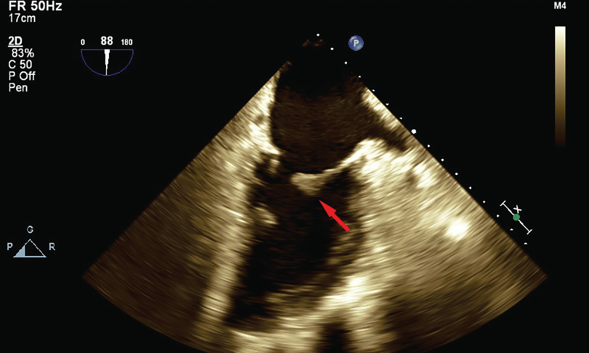 An unusual case of non‐infective endocarditis in undiagnosed ...