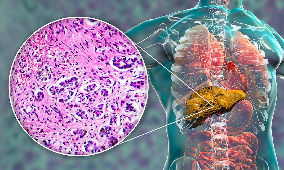 Australian recommendations for the management of hepatocellular ...