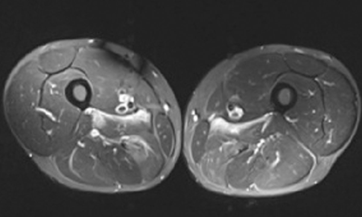Necrotising autoimmune myopathy: a differential diagnosis for deranged ...