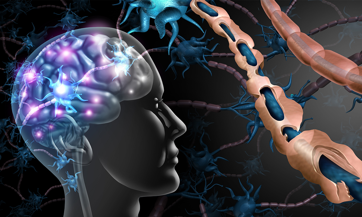 What causes multiple sclerosis? Getting closer to the answers | The ...