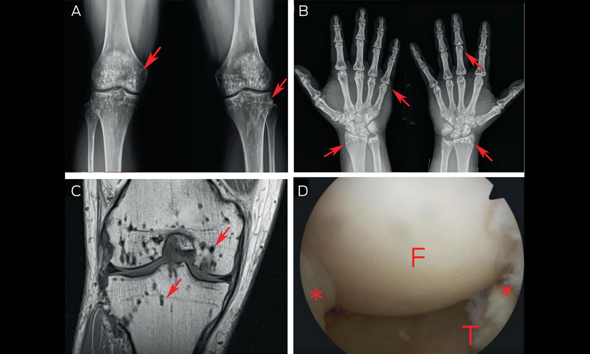 Osteopoikilosis: benign bone islands in periarticular bones | The ...