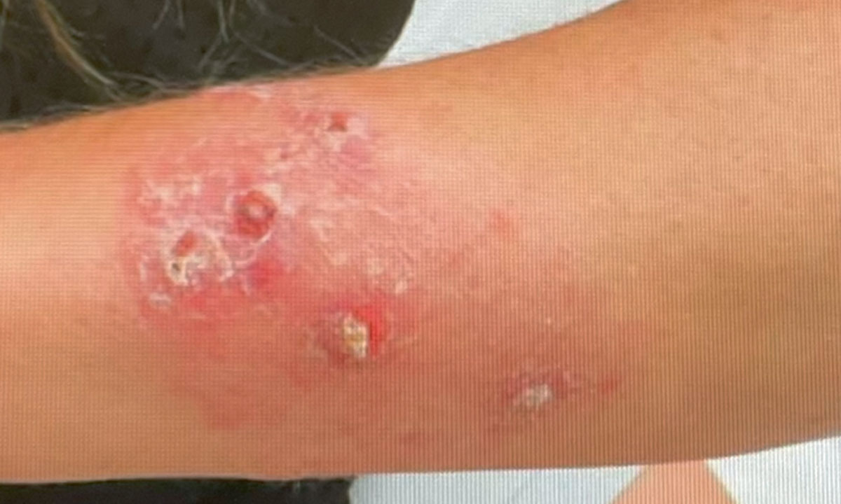 Mycobacterium haemophilum in a patient with inflammatory bowel disease ...