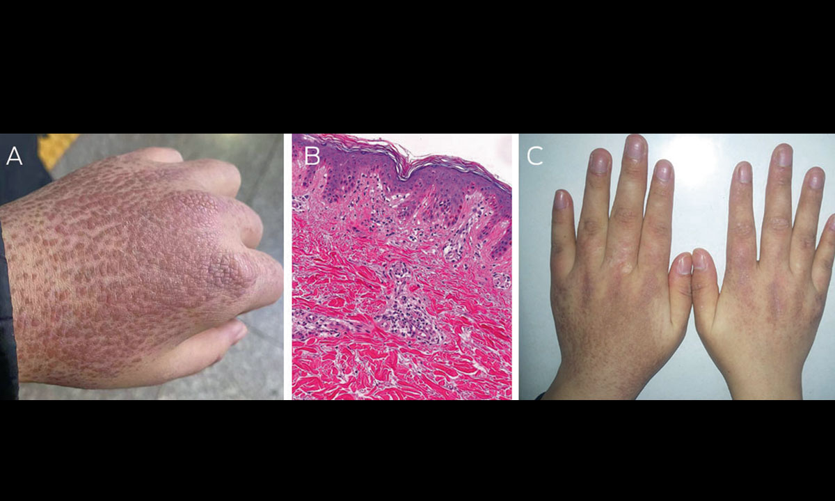 Wong‐type dermatomyositis | The Medical Journal of Australia