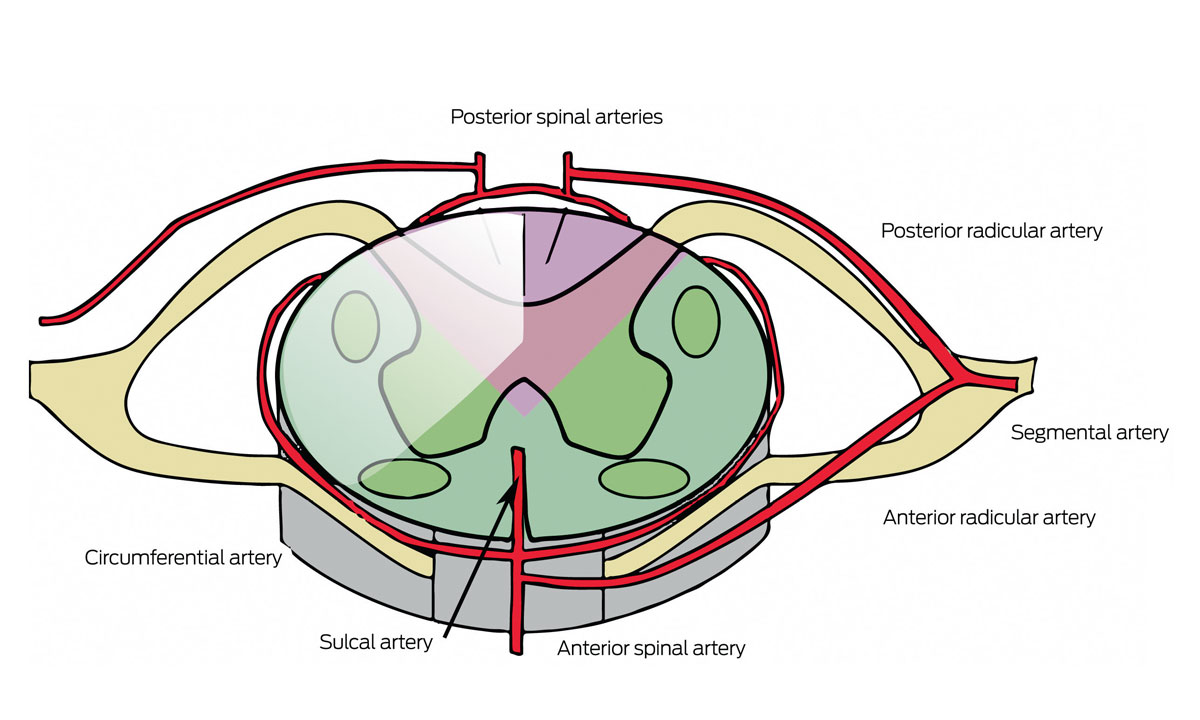 Cervical cord infarction mimicking migraine in a patient with vertebral ...