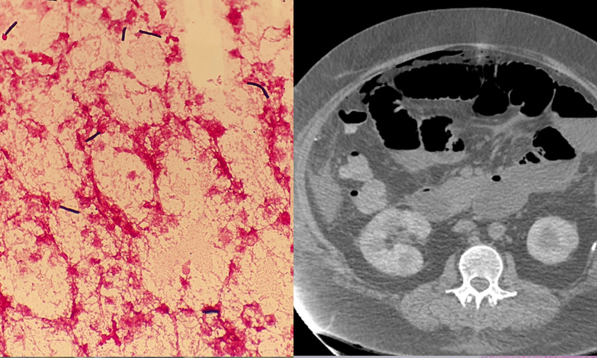 Human Clostridium chauvoei necrotising enterocolitis | The Medical ...