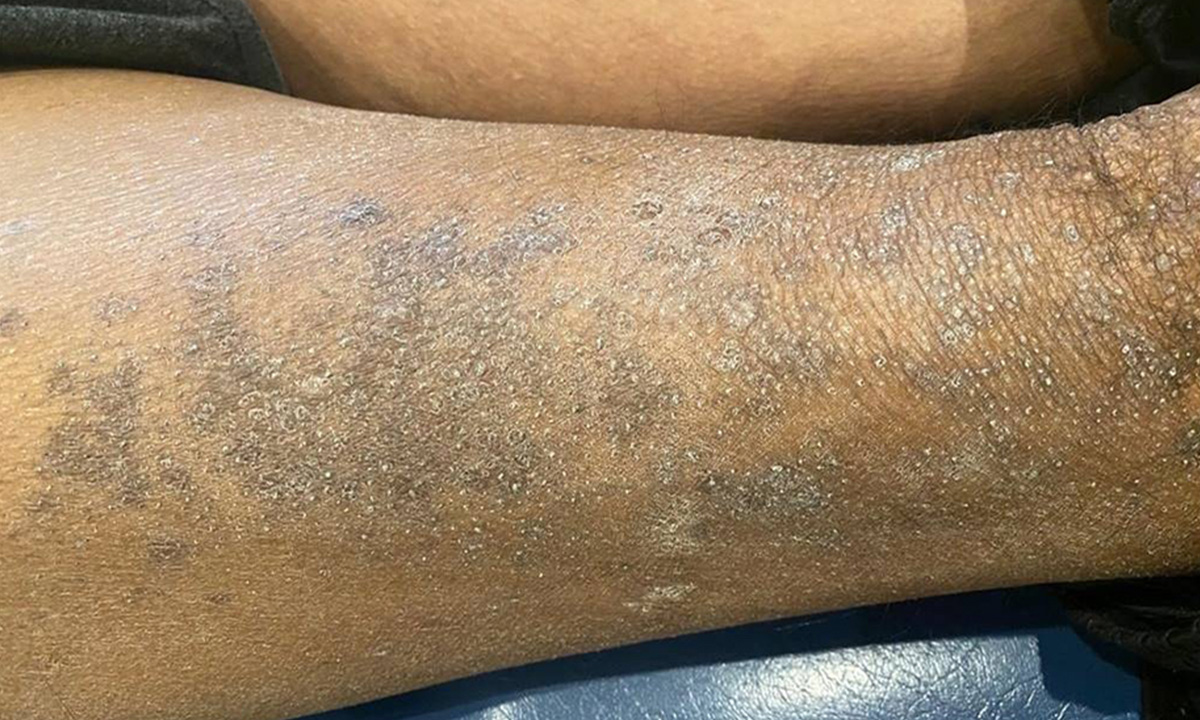 Phrynoderma: an under‐recognised condition reflecting nutritional ...