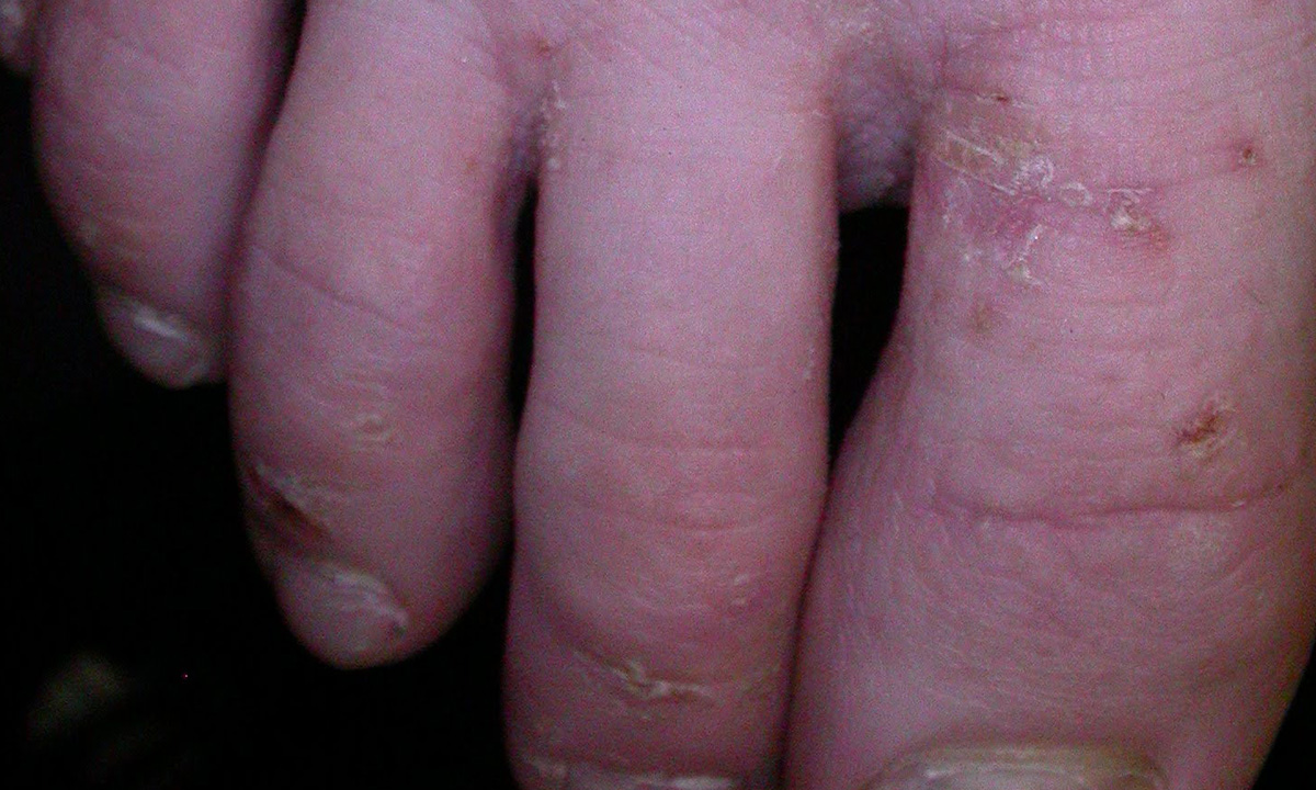 Scabies: a clinical update | The Medical Journal of Australia