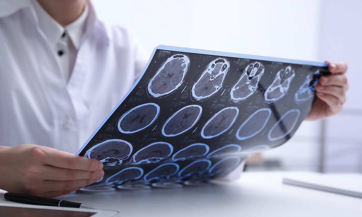 Consensus recommendations on multiple sclerosis management in Australia ...