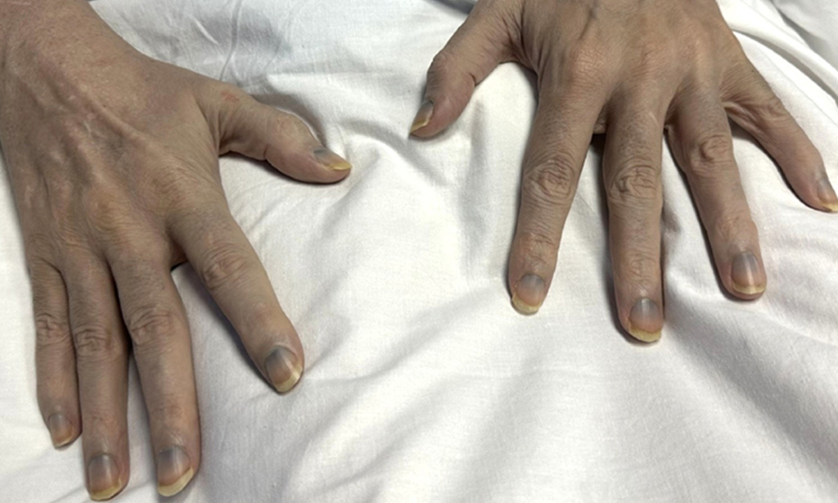 No silver lining with health misinformation: argyria caused by ...