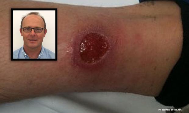 MJA Podcasts 2019 Episode 15: Pitfalls diagnosing Buruli ulcer, with A ...